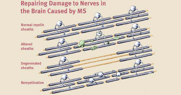 Is Remyelination a Miracle Treatment for MS?